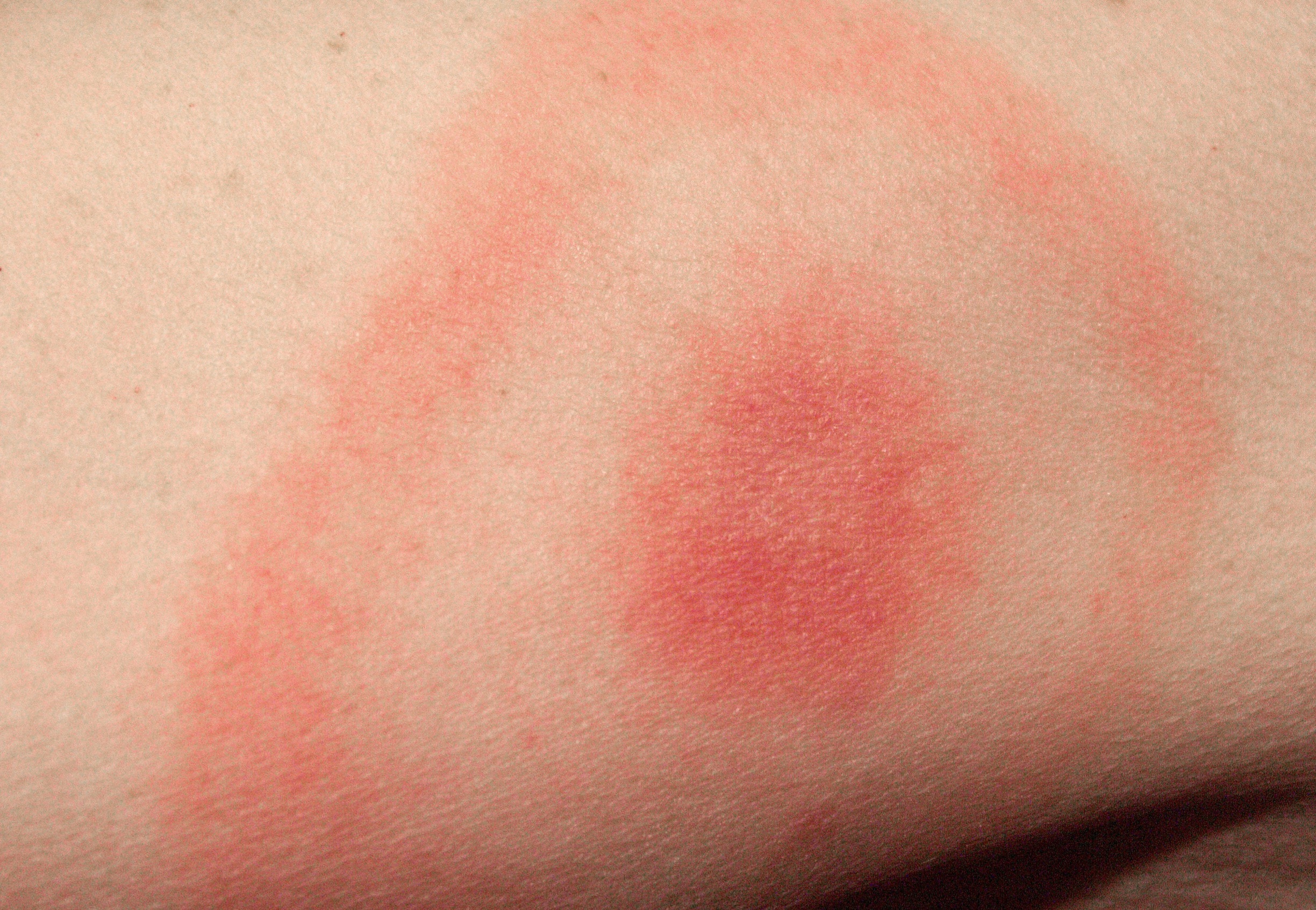 Morsa da una zecca a 14 anni, a 22 le viene diagnosticata la malattia ...