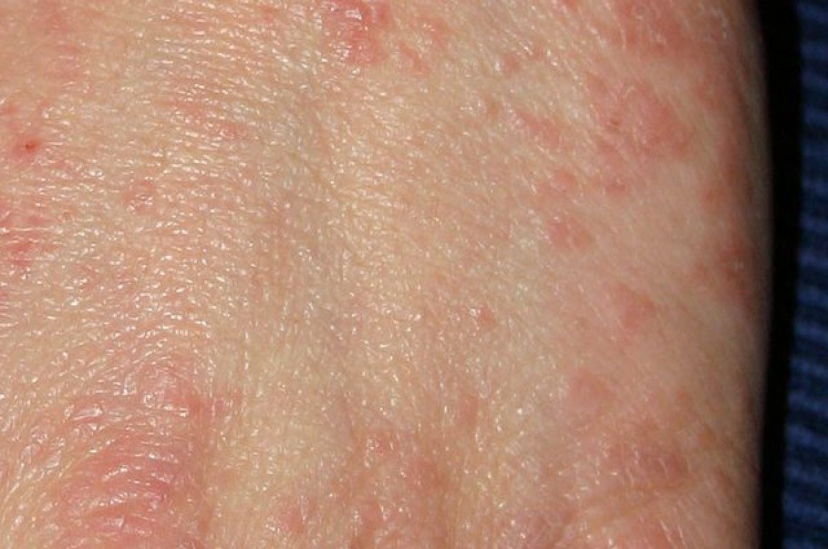 Acaro della Scabbia: la disinfestazione degli ambienti | Ongaro ...